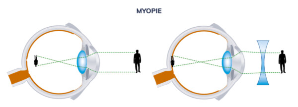 La myopie : causes et traitements en Yvelines, Le Port Marly - OPH78